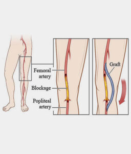 Vascular Bypass Surgery In Vadodara